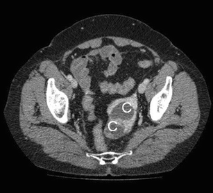 Struma ovarii: role of imaging? | SpringerLink