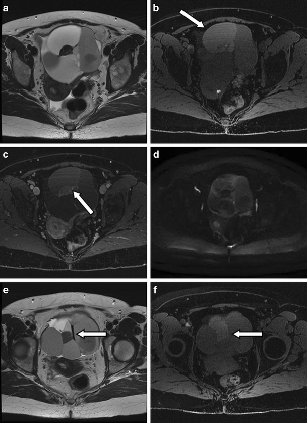Struma ovarii: role of imaging? | SpringerLink