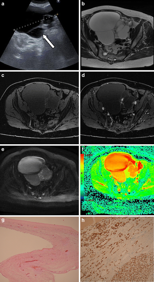 Struma ovarii: role of imaging? | SpringerLink