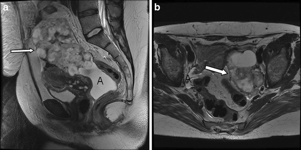 Struma ovarii: role of imaging? | SpringerLink