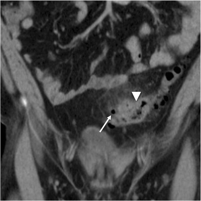 Bowel wall thickening at CT: simplifying the diagnosis | Insights into ...