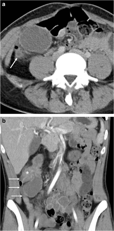 Bowel wall thickening at CT: simplifying the diagnosis | SpringerLink