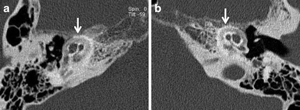 Imaging in otosclerosis: A pictorial review | SpringerLink