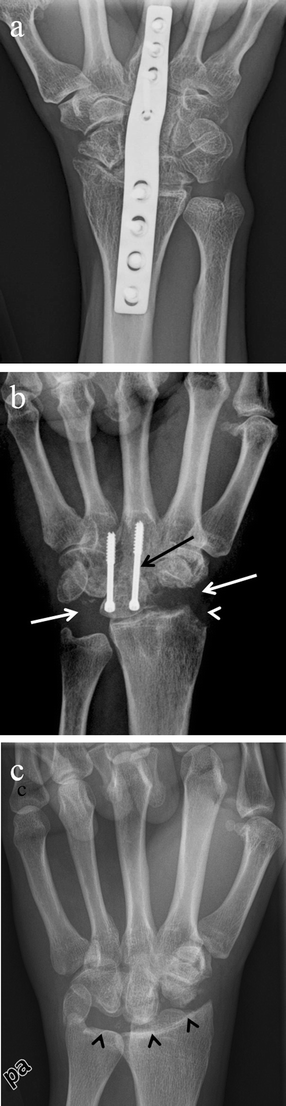 Scapholunate advanced collapse: a pictorial review | Insights into ...