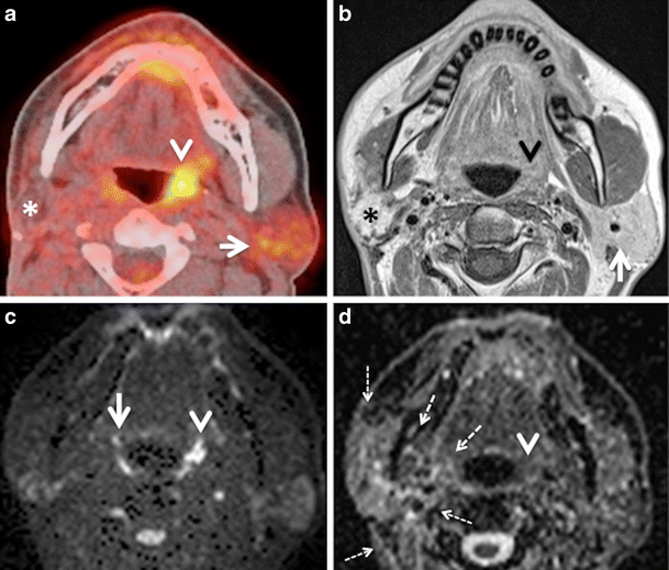 FDG-PET/CT pitfalls in oncological head and neck imaging | Insights ...