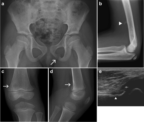Pitfalls in the diagnosis of common benign bone tumours in children ...