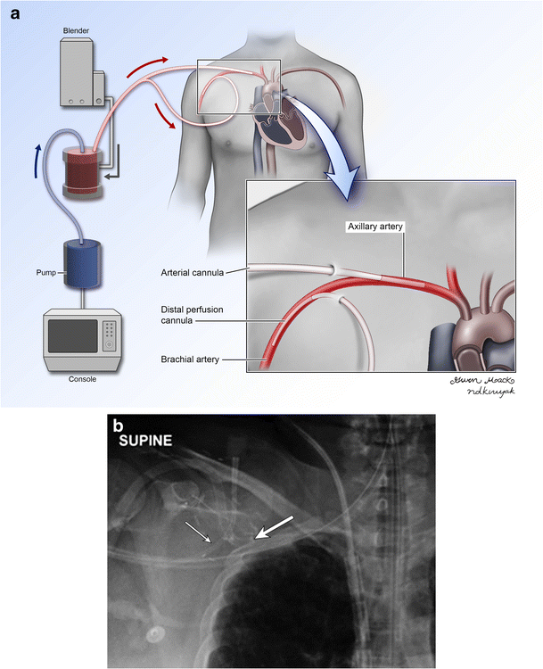 Imaging adults on extracorporeal membrane oxygenation (ECMO) | SpringerLink