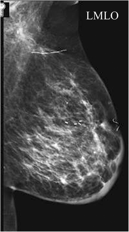 A practical approach to imaging the axilla | SpringerLink
