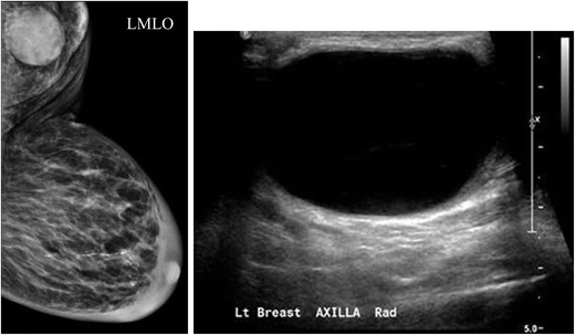 A practical approach to imaging the axilla | SpringerLink