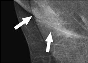 A practical approach to imaging the axilla | SpringerLink