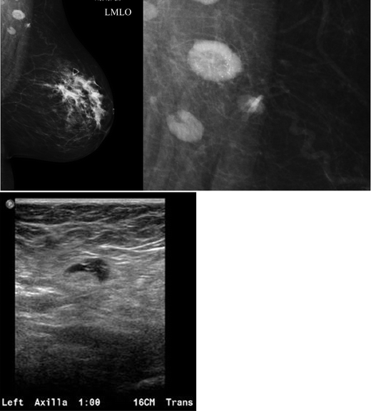 A practical approach to imaging the axilla | SpringerLink