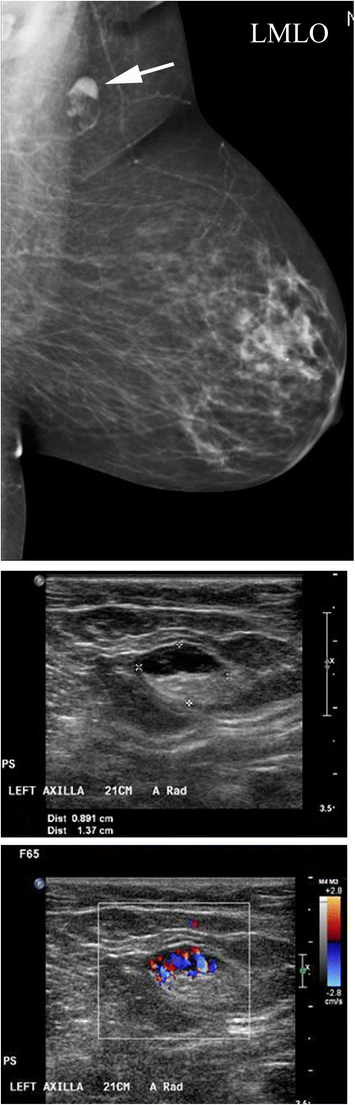 A practical approach to imaging the axilla | SpringerLink
