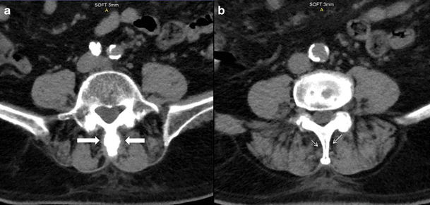 Baastrup’s disease (kissing spines syndrome): a pictorial review ...