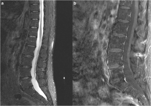 Baastrup’s disease (kissing spines syndrome): a pictorial review ...