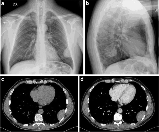 Imaging characteristics of pleural tumours | SpringerLink
