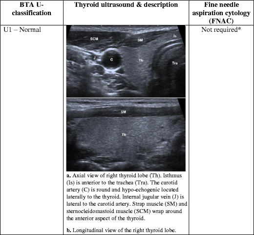 Ultrasonography of thyroid nodules: a pictorial review | SpringerLink