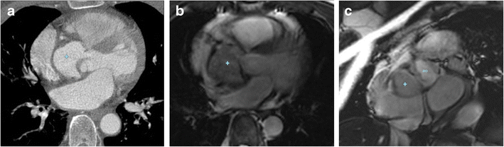 Interventricular membranous septal aneurysm: CT and MR manifestations ...