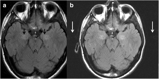 Bilateral temporal lobe disease: looking beyond herpes encephalitis ...