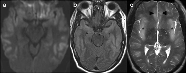 Bilateral temporal lobe disease: looking beyond herpes encephalitis ...