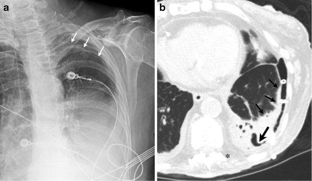 Demystifying the persistent pneumothorax: role of imaging | SpringerLink