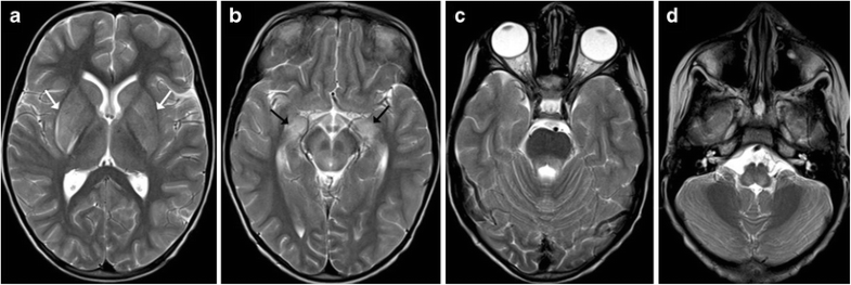 Paediatric brainstem: A comprehensive review of pathologies on MR ...