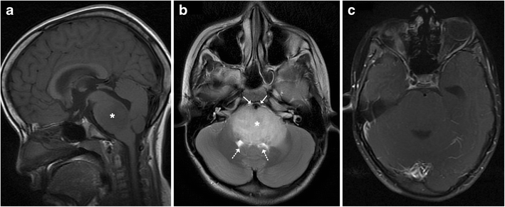 Paediatric brainstem: A comprehensive review of pathologies on MR ...