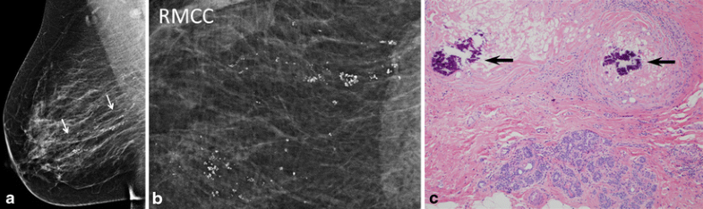 Idiopathic granulomatous mastitis: imaging update and review | SpringerLink
