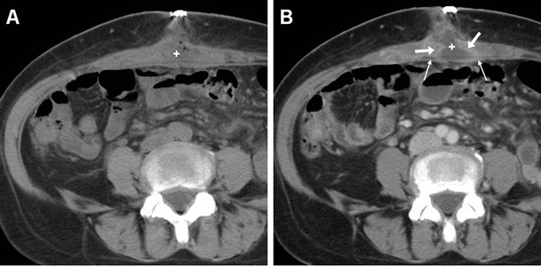 Multidetector CT of expected findings and early postoperative ...