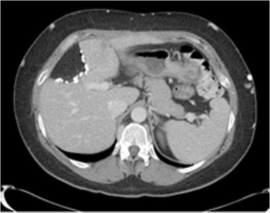 Causes of hepatic capsular retraction: a pictorial essay | Insights ...