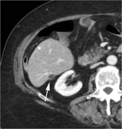 Causes of hepatic capsular retraction: a pictorial essay | SpringerLink