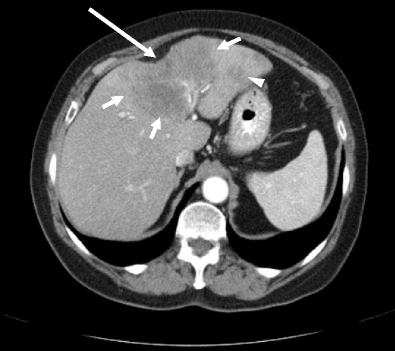 Causes of hepatic capsular retraction: a pictorial essay | SpringerLink