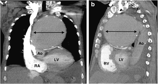 Cross-sectional imaging of aortic infections | SpringerLink