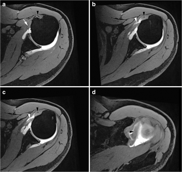 Multi-modal imaging of the subscapularis muscle | SpringerLink