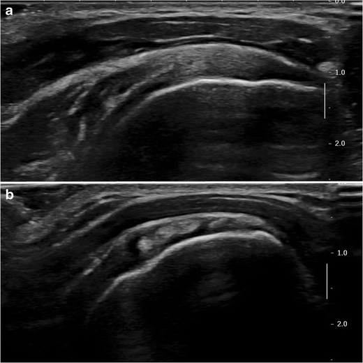 Multi-modal imaging of the subscapularis muscle | Insights into Imaging ...