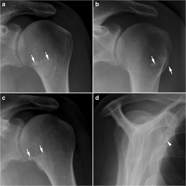 Multi-modal imaging of the subscapularis muscle | Insights into Imaging ...