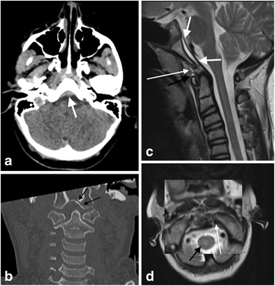 The craniocervical junction: embryology, anatomy, biomechanics and imaging in blunt trauma ...