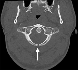 The craniocervical junction: embryology, anatomy, biomechanics and ...