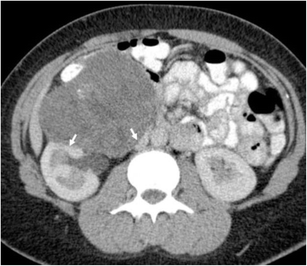 Radiological diagnosis of perinephric pathology: pictorial essay 2015 ...
