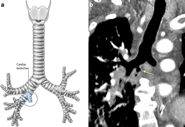Beyond bronchitis: a review of the congenital and acquired ...