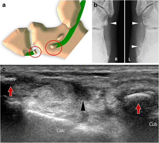 Os peroneum imaging: normal appearance and pathological findings ...