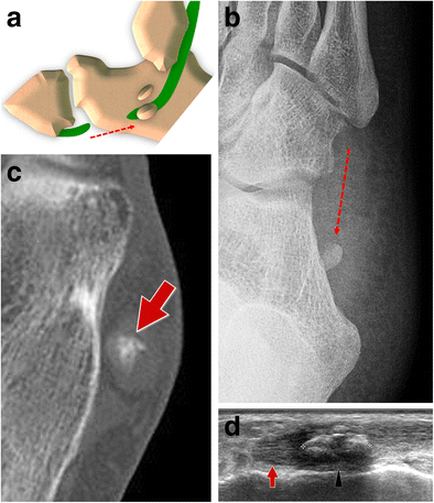 Os peroneum imaging: normal appearance and pathological findings ...