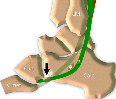 Os peroneum imaging: normal appearance and pathological findings ...