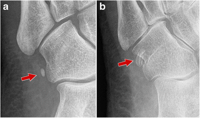 Os peroneum imaging: normal appearance and pathological findings ...