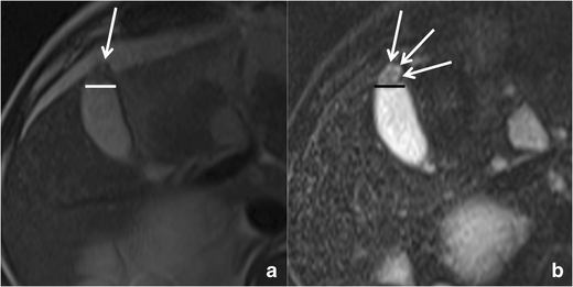 Gallbladder adenomyomatosis: imaging findings, tricks and pitfalls ...