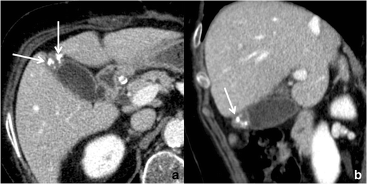 Gallbladder adenomyomatosis: imaging findings, tricks and pitfalls ...