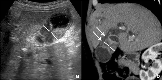 Gallbladder adenomyomatosis: imaging findings, tricks and pitfalls ...