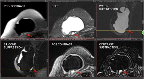 Breast magnetic resonance imaging: tips for the diagnosis of silicone ...