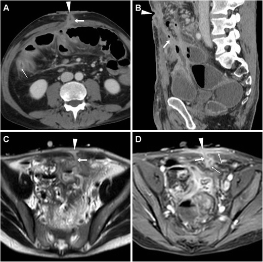 Enterocutaneous fistulas: a primer for radiologists with emphasis on CT ...