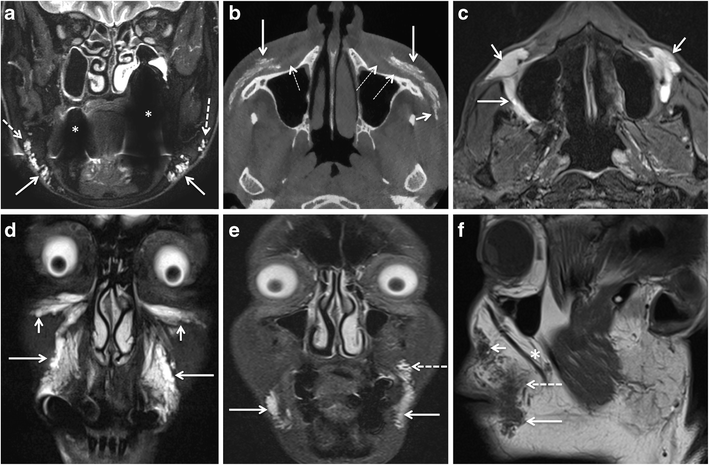 Injectable facial fillers: imaging features, complications, and ...