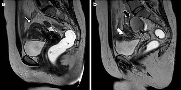 MRI for adenomyosis: a pictorial review | Insights into Imaging | Full Text